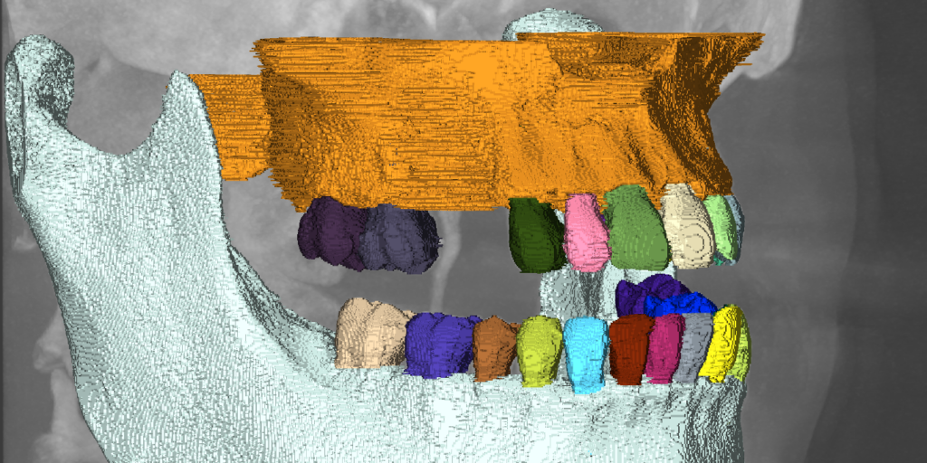 Segmentation and identification of tooth instances in cone-beam CT scans – helmholtz-imaging.de